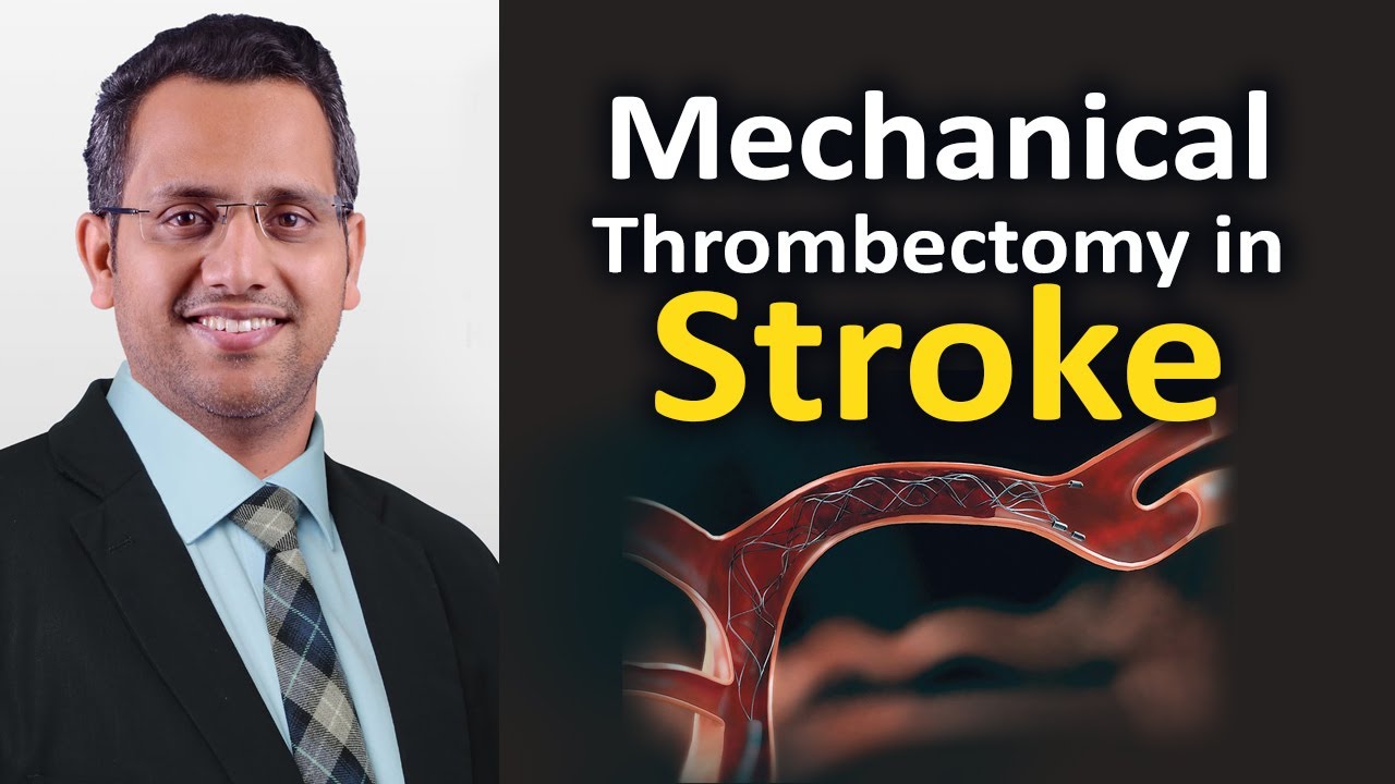 Mechanical Thrombectomy in treating brain stroke | Dr Dilip Kumar ...