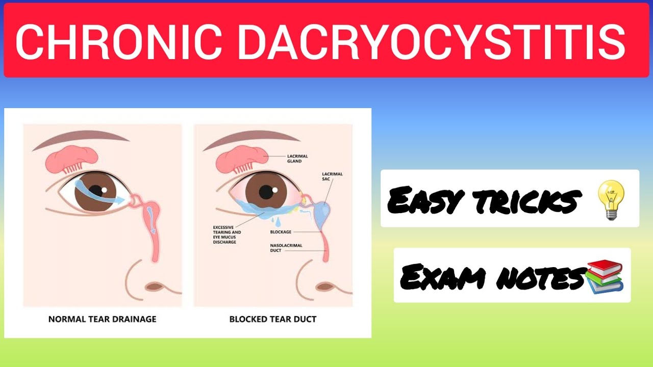 |Chronic Dacryocystitis In hindi |#opthalmology #CDCR #aiapget #BAMS ...