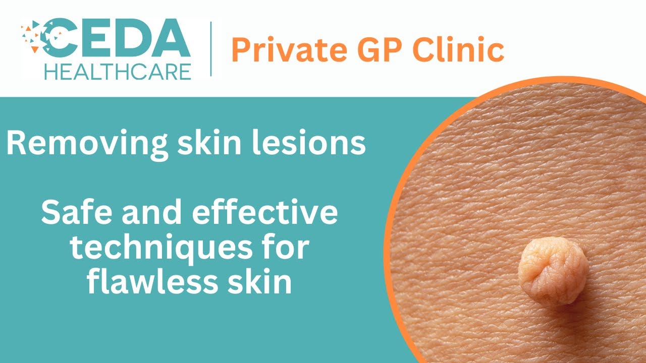 Removing skin lesions: Safe and effective techniques - YouTube