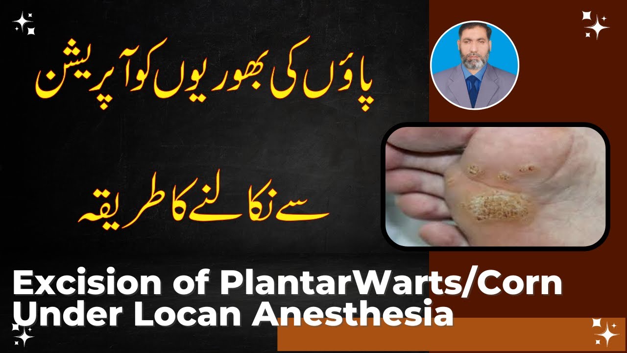 Excision of Plantar Corn/Warts and callosity under local anesthesia ...