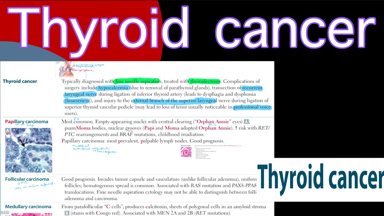 Thyroid cancer in Hindi/Urdu by first aid for USMLE step 1 - YouTube