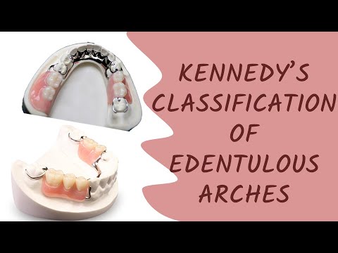 KENNEDY'S CLASSIFICATION OF EDENTULOUS ARCHES || Prosthodontics || RPD ...