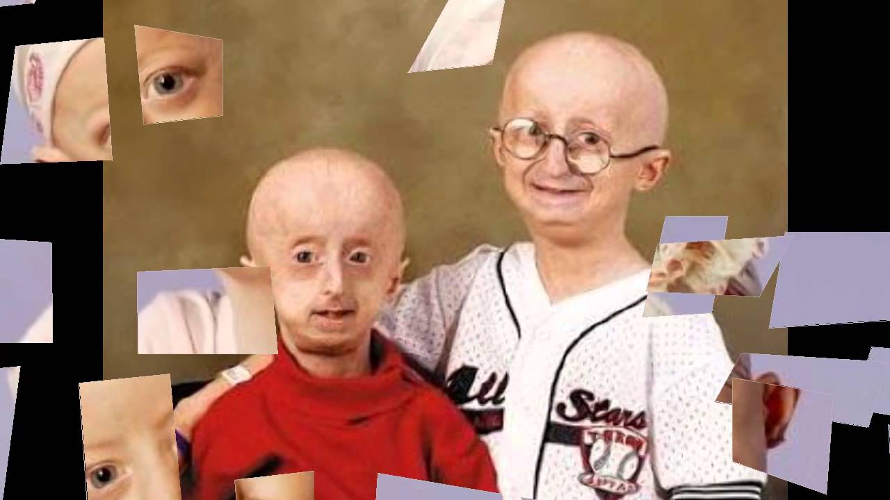 Progeria - YouTube