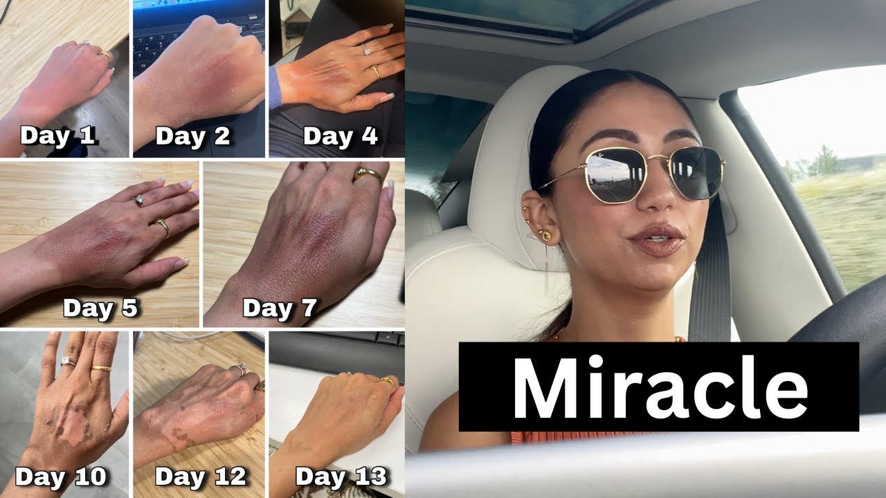 How I recovered my Burnt Hand In two Weeks || Absolute Miracle ...