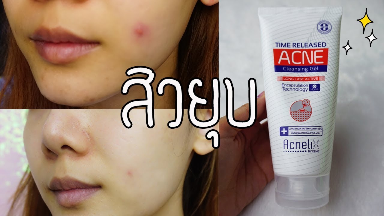 Acnelix Cleansing gel เจลล้างหน้าสำหรับผิวเป็นสิวที่ไม่ได้มีดีแค่ ...