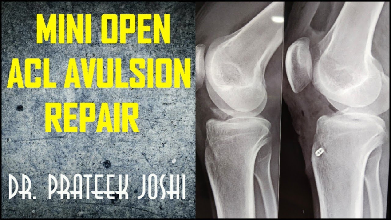 Mini Open ACL Avulsion Repair by Suture Pull Out Technique | Dr ...