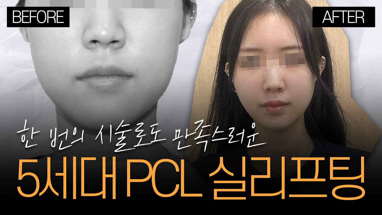 부산리프팅 오래 가는 유지기간 실리프팅 전후 팔자주름 심부볼 얼굴라인 교정 실리프팅 부산리프팅 Youtube