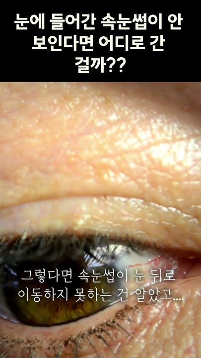 눈에 눈썹이 들어갔는데 안 보인다 눈 뒤로 넘어갔을까 눈썹을 안전하게 제거하는 방법 Youtube