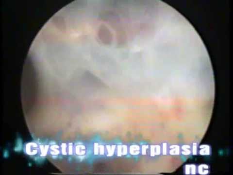 Cystic Hyperplasia on Diagnostic Hysteroscopy - YouTube
