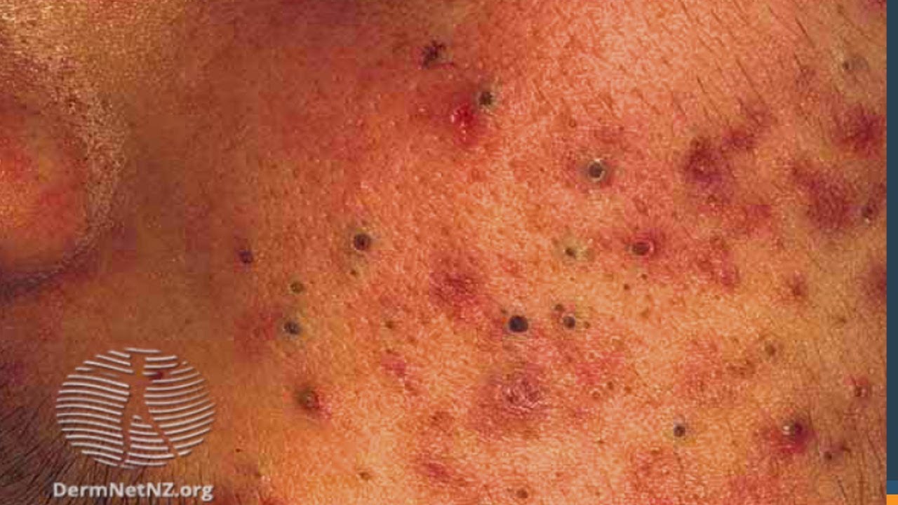 3 Cysts 7 Blackheads And 12 Pimples Popped Comedones Youtube