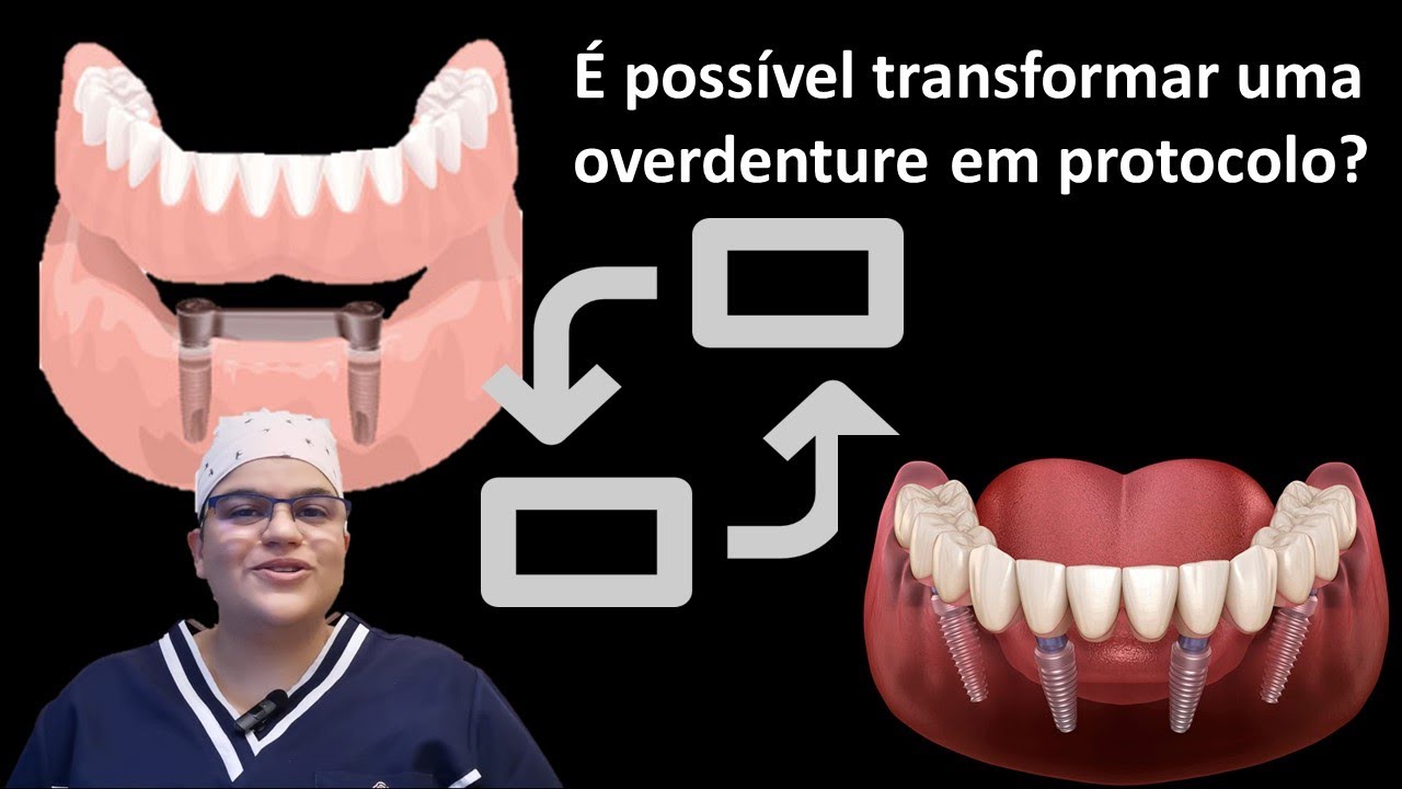 É possível transforma uma overdenture em um protocolo?| Dra Bianca Rosa | Clínica Bianca Rosa ...