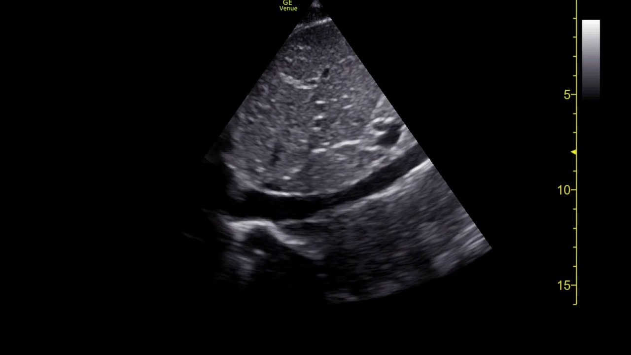 IVC Collapsing Reference 4 - YouTube