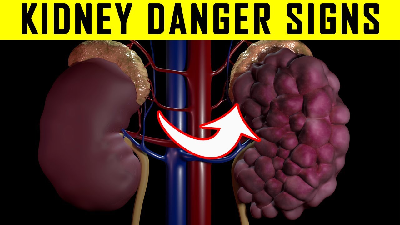 10 Alarming Signs that your KIDNEY is in DANGER - YouTube