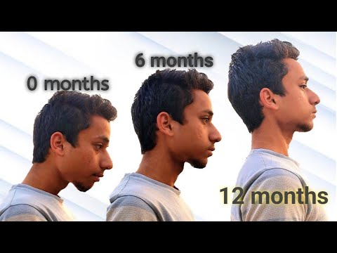 ULTIMATE MEWING GUIDE | mew properly | improve facial aesthetics - YouTube