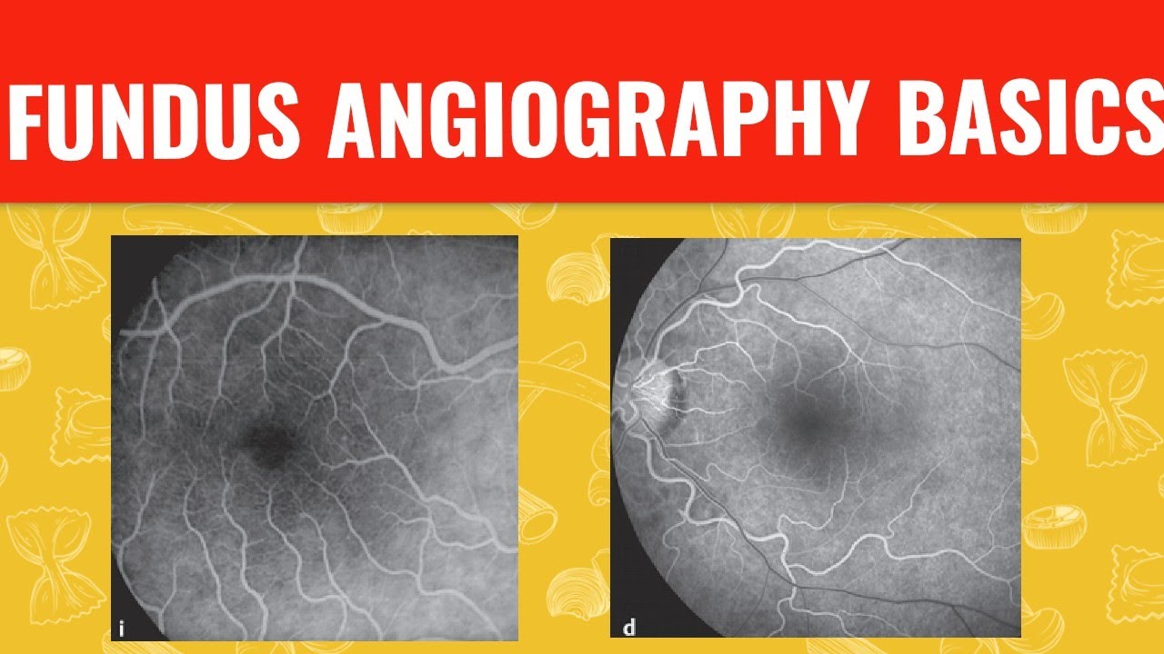 FFA course || FUNDUS FLUORESCEIN ANGIOGRAPHY || - YouTube