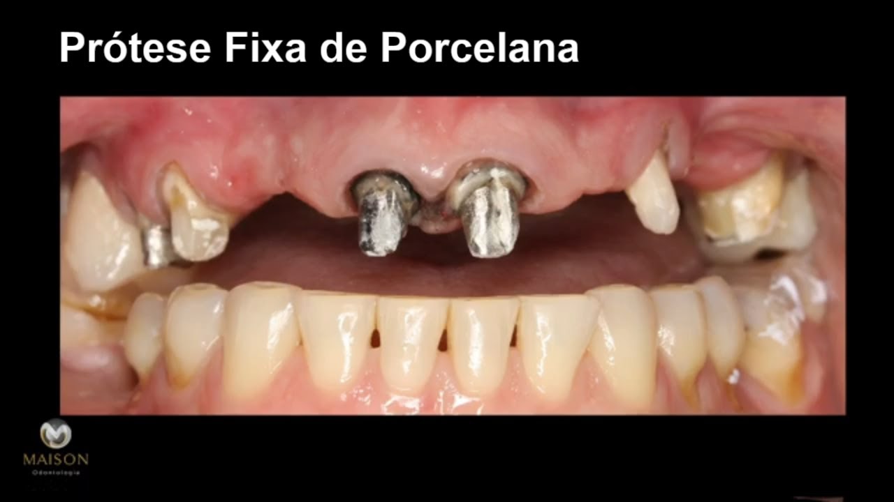 Protese Fixa de Porcelana - YouTube