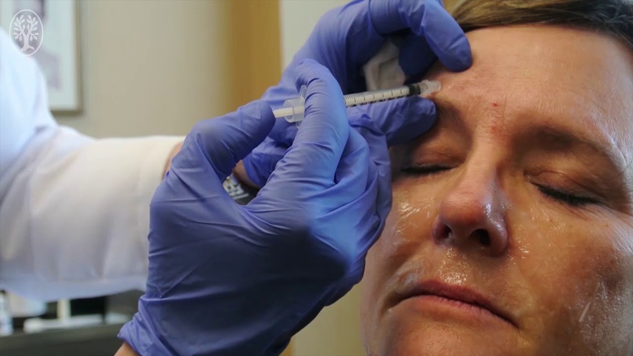 Video 5 10 Neurotoxin Injection for Glabellar Frown Lines - YouTube
