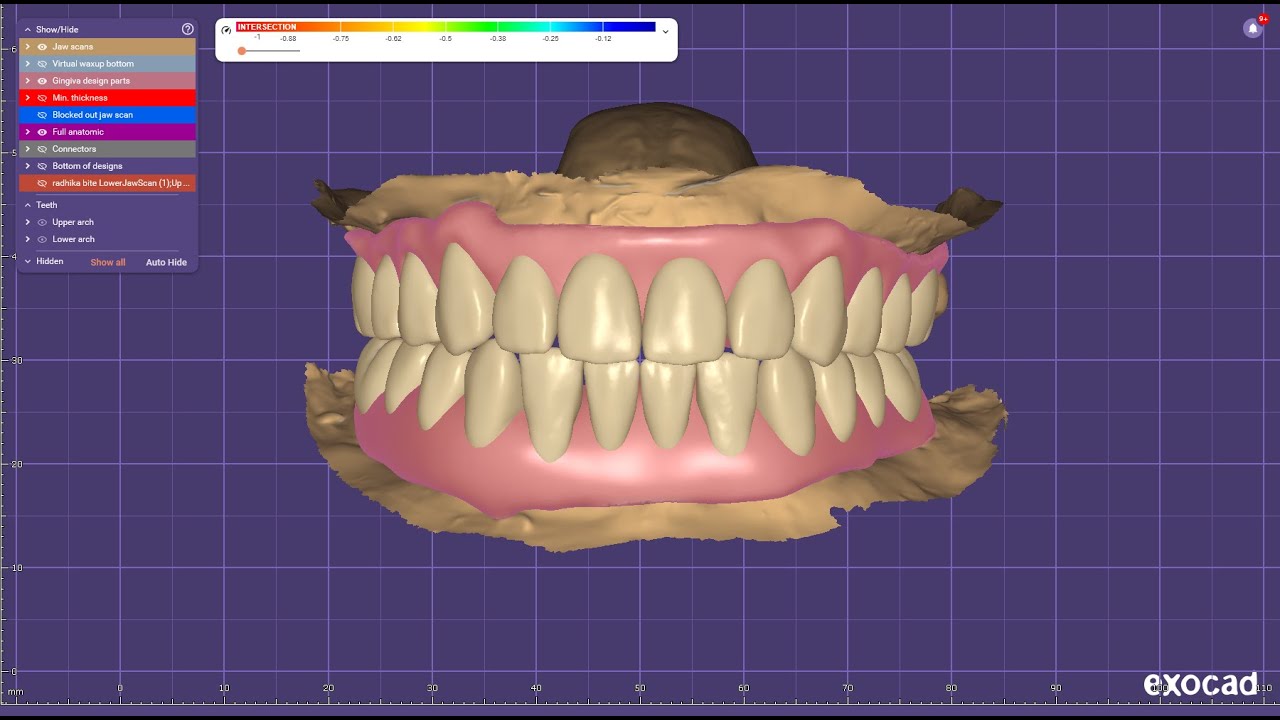 FMR - Designing for upper full arch on substructure & lower full arch ...