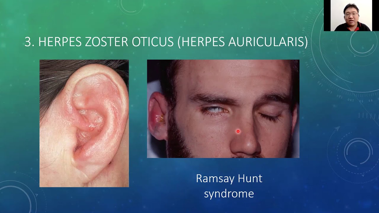 Pathology of the ear - YouTube