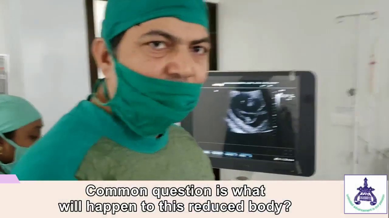 Fetal Reduction Procedure by Dr. Jayesh Patel, Paaranu IVF, Sruat ...