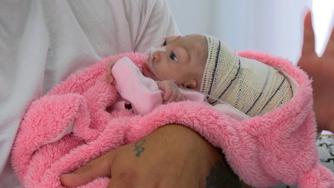 Bebê nasce com duas condições raras ENCEFALOCELE e ACRANIA - YouTube