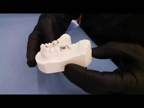 Aparelho Disjuntor Mandibular fixo - YouTube