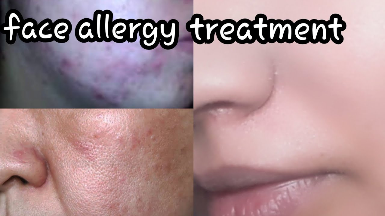 Remove allergy redness and pimples on face/allergy and pimple treatment ...
