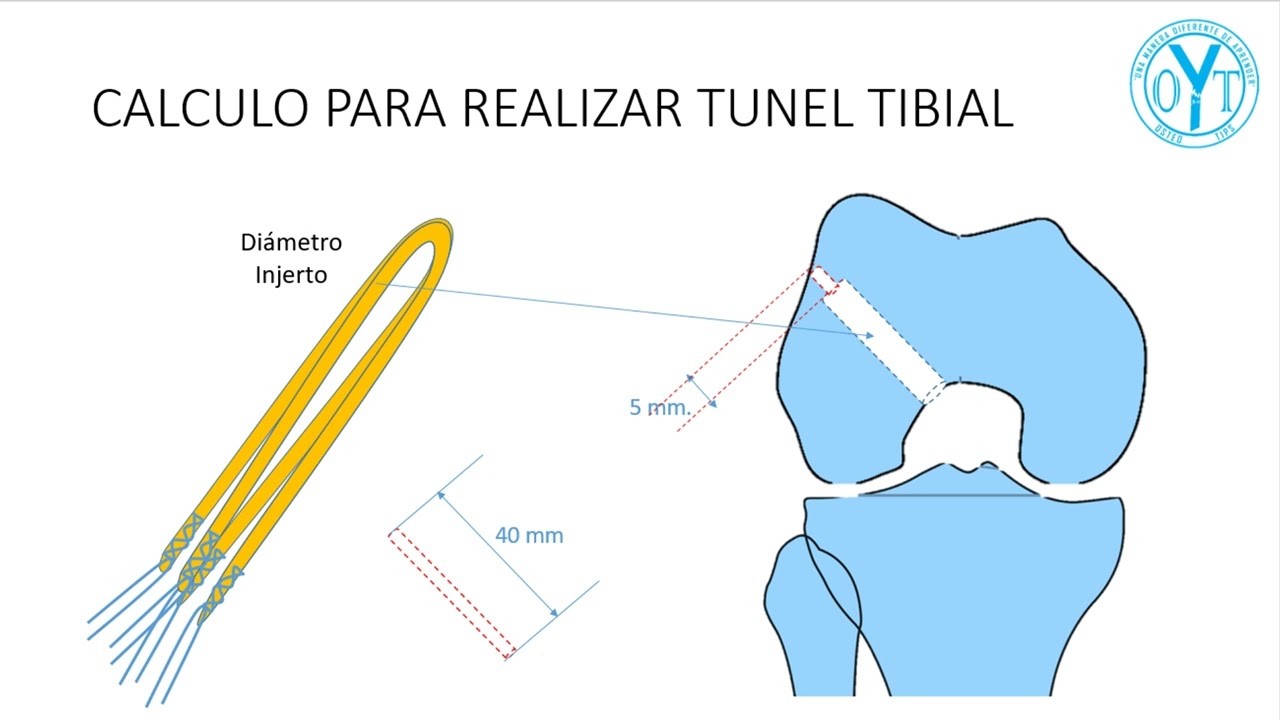 Calculo para realizar el túnel tibial, con injerto STRI - YouTube