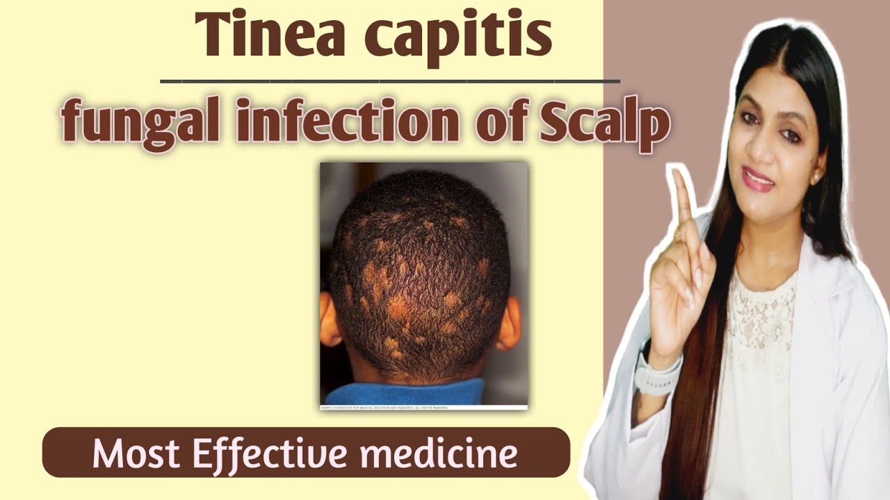fungal infection on scalp ( tinea capitis ) | causes, risk factors ...