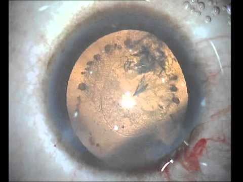 Dr Agarwal's Eye Hospital Traumatic Cataract with IOFB 2 cases - YouTube