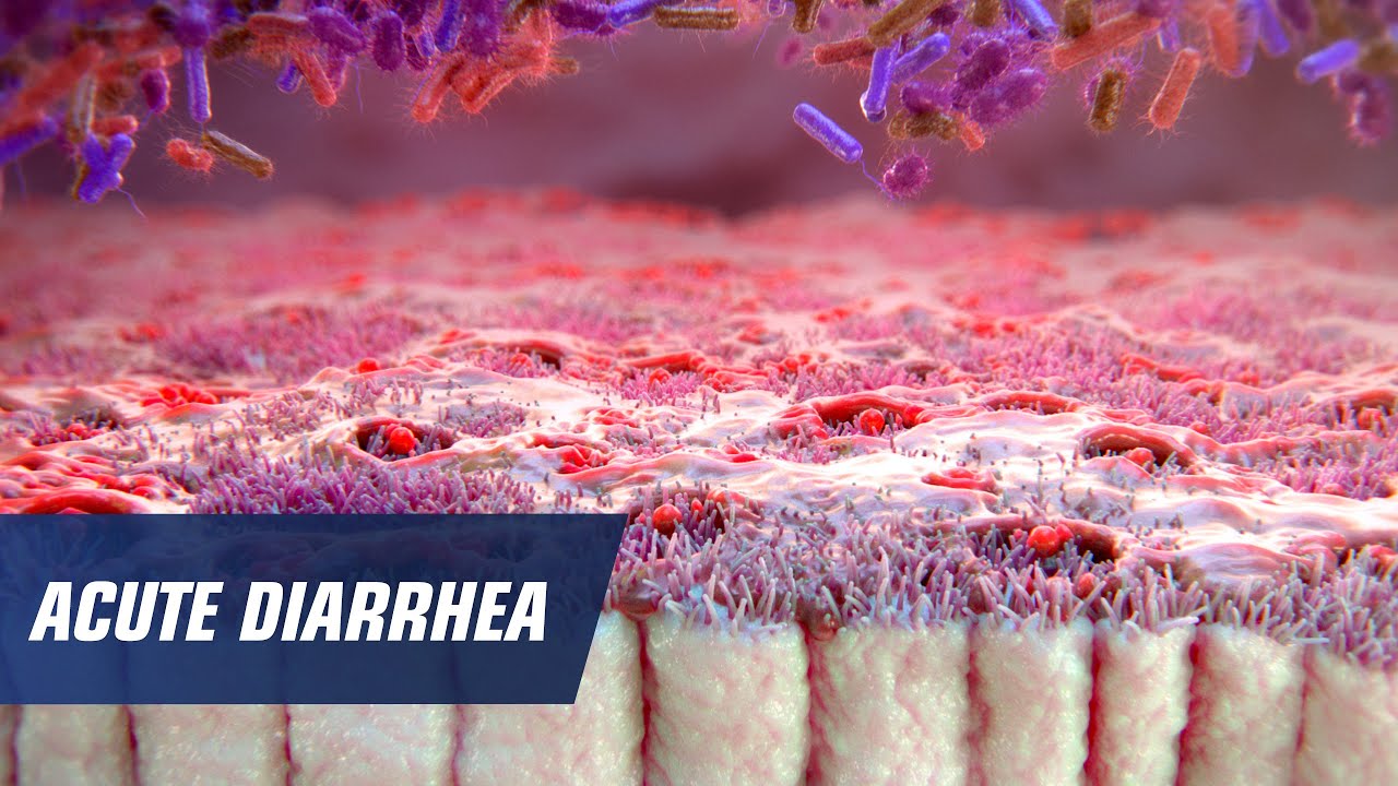 Acute diarrhea - YouTube