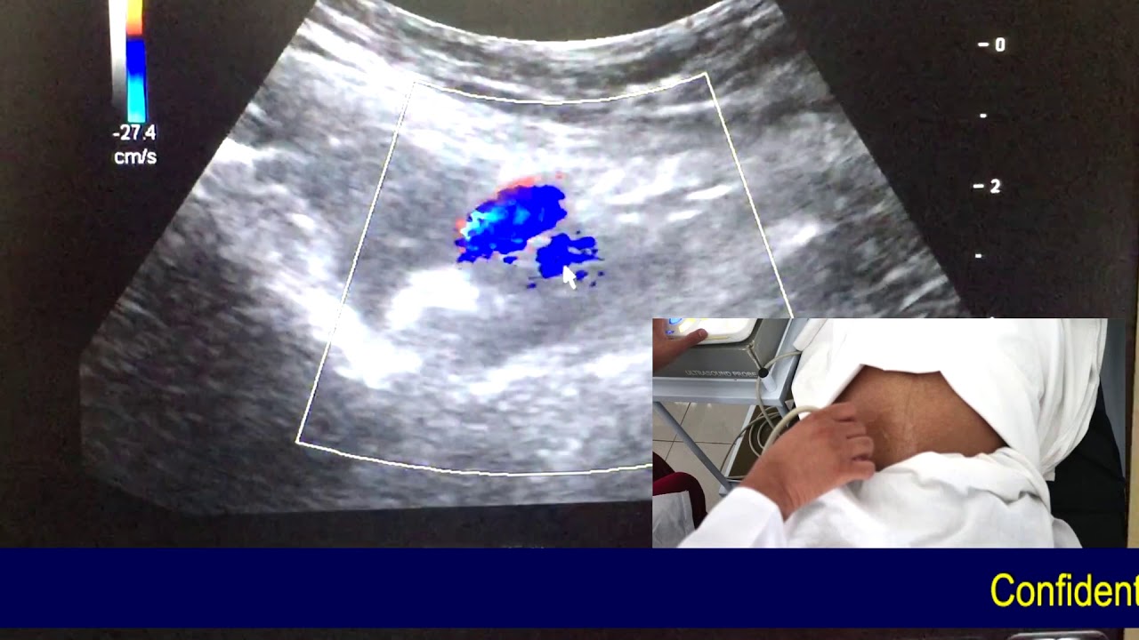 Confident Color Doppler Technique to pick the uterine artery in ...