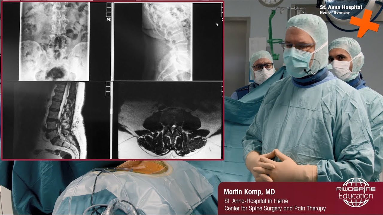 RIWOspine Full-endoscopic Spine Surgery - Case of caudal migrated disc ...