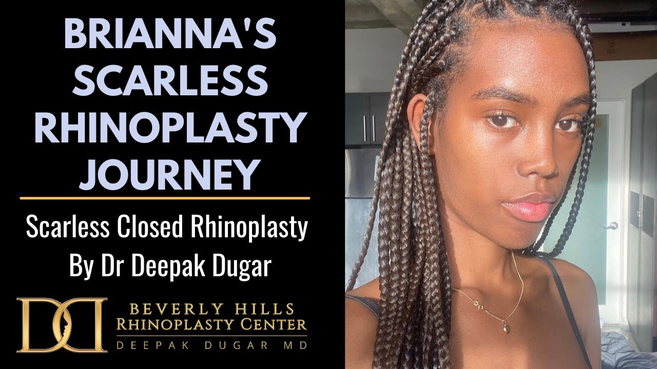 Brianna's (Ethnic Nose Job) Rhinoplasty Journey - Dr. Deepak Raj Dugar ...