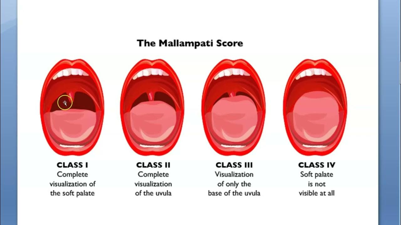 anesthesia-mallampati-score-grading-mp-airway-evaluation-open-mouth