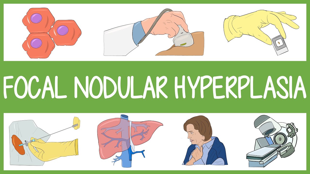 Focal Nodular Hyperplasia - YouTube
