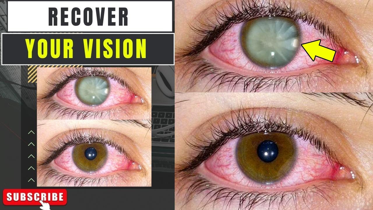Unbelievable! 🤩 Restores eyesight by 100%! Everyone is useful and ...