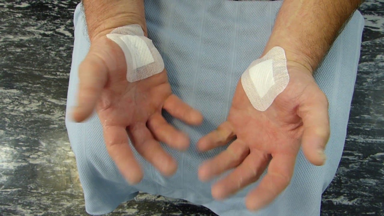 Contracted Fingers Treatment (Dupuytren's contracture) - YouTube
