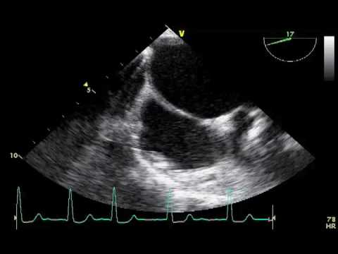 TEE RA pectinate muscle - YouTube
