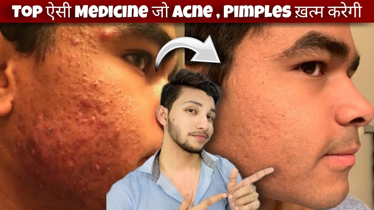 Acne ,Pimples के लिए Guranteed Medicine | Best Capsule for Acne 100% ...