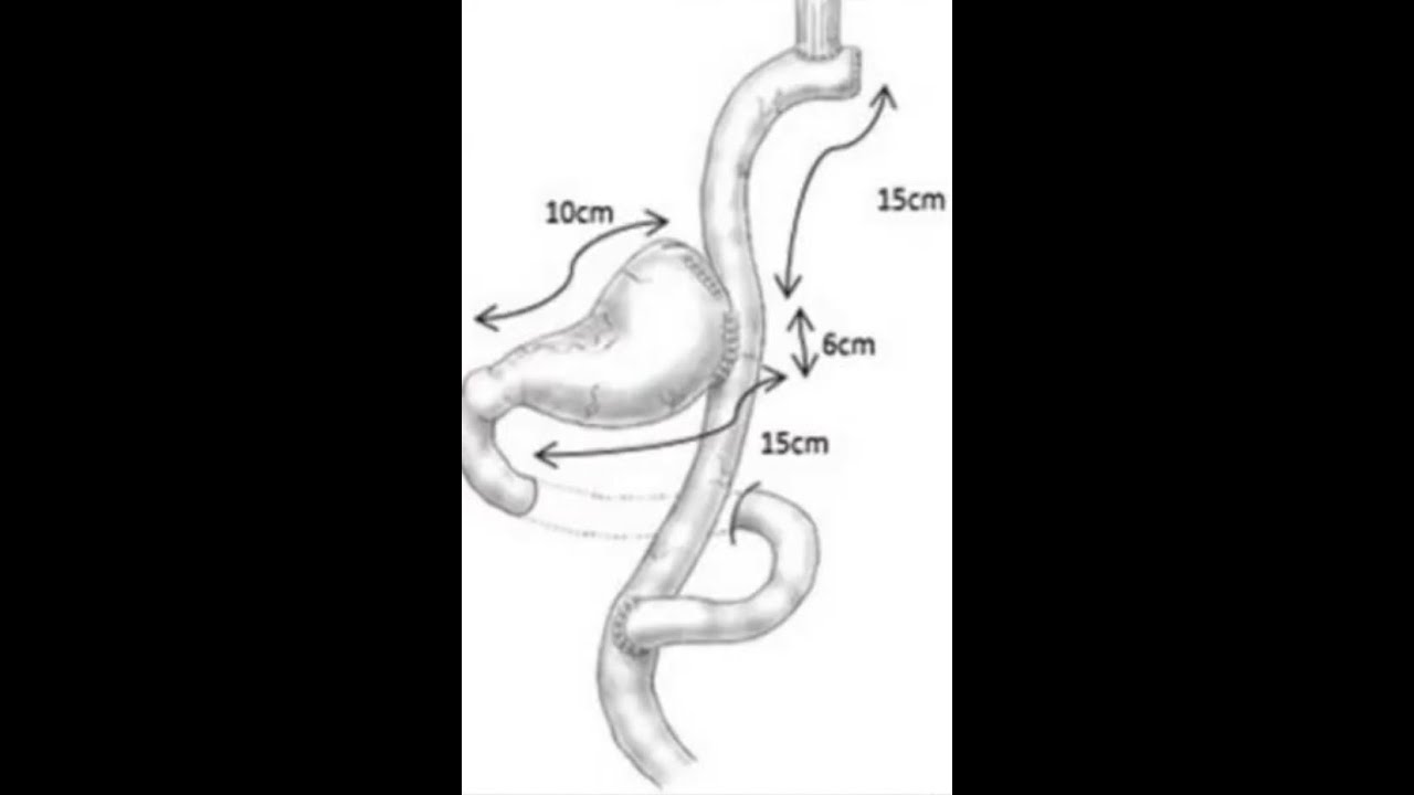 Proximal gastrectomy with double-tract reconstruction - YouTube