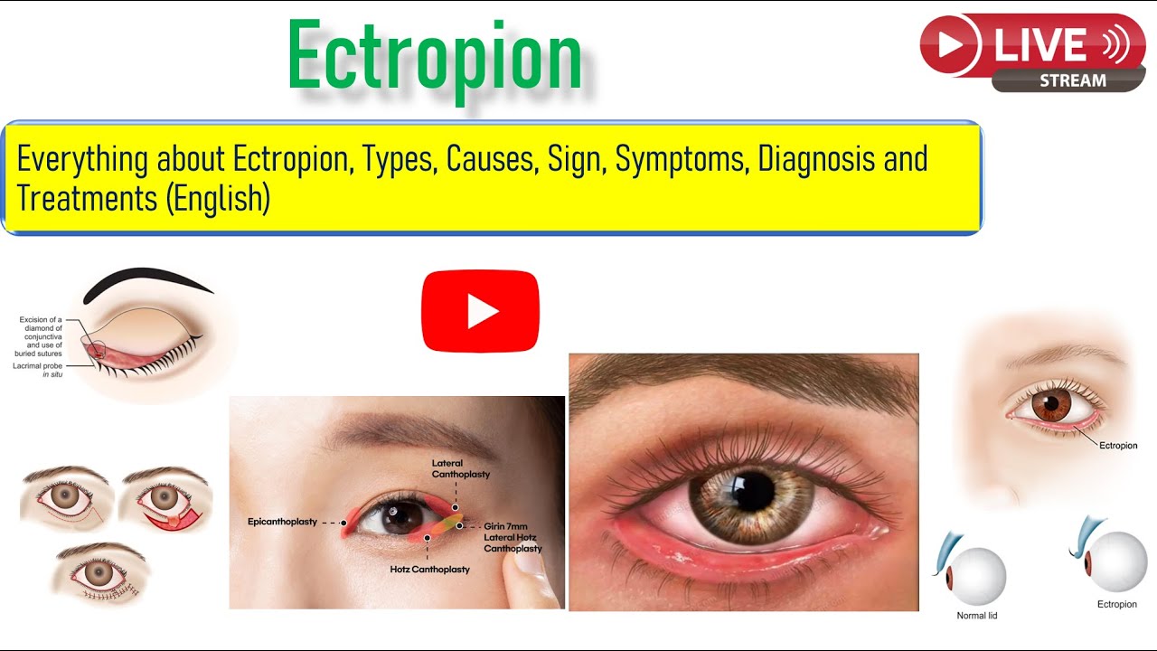 Everything about ectropion, Types, Sign, Symptoms and Treatment option ...