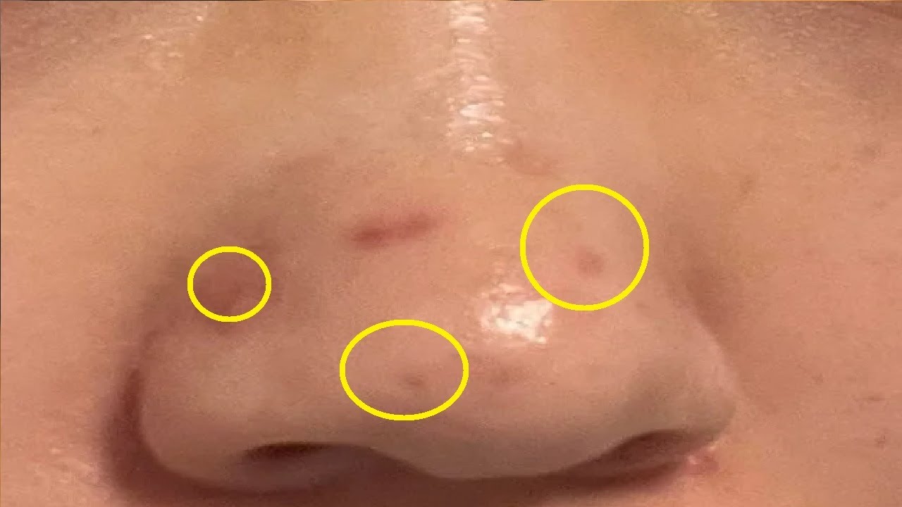 How To Get Rid Of Pimple Scars On Nose Naturally YouTube how-to-get-rid-of-pimple-scars-on-nose-naturally-youtube