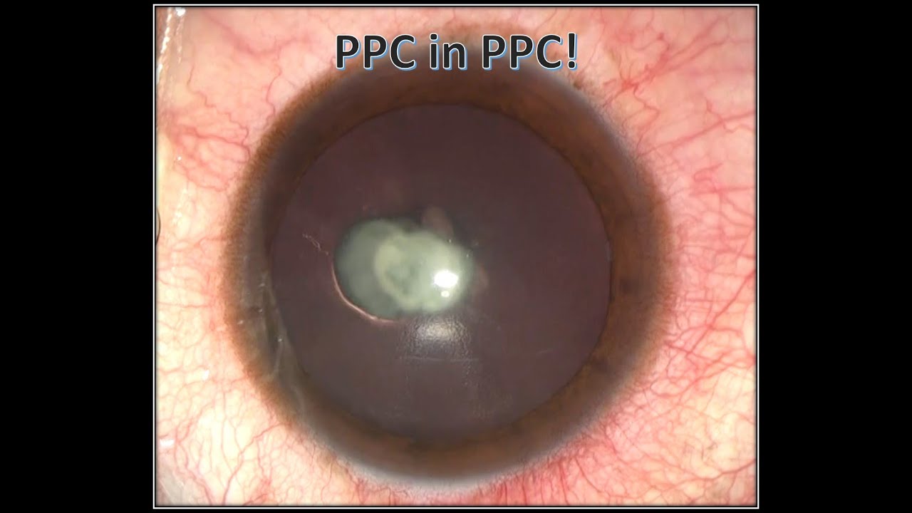 PPC in PPC - YouTube