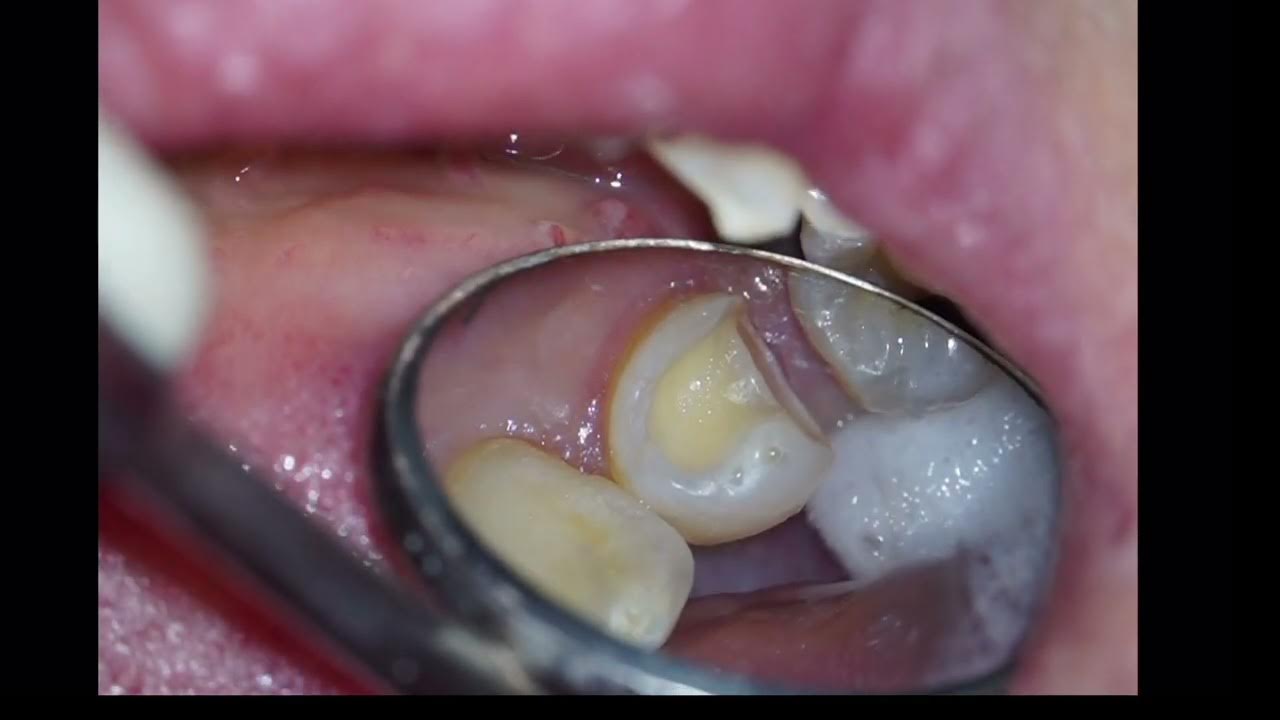 ceramic inlay preparation for e.max - YouTube