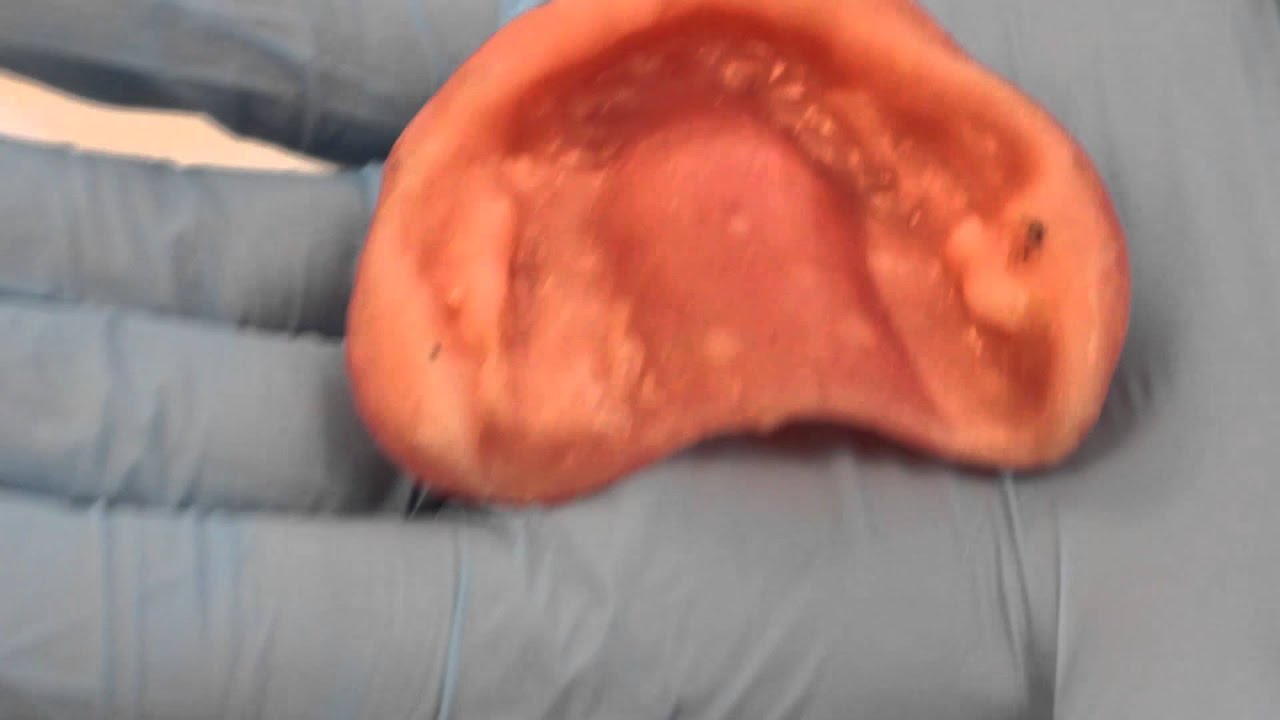 Immediate Denture Reline - YouTube