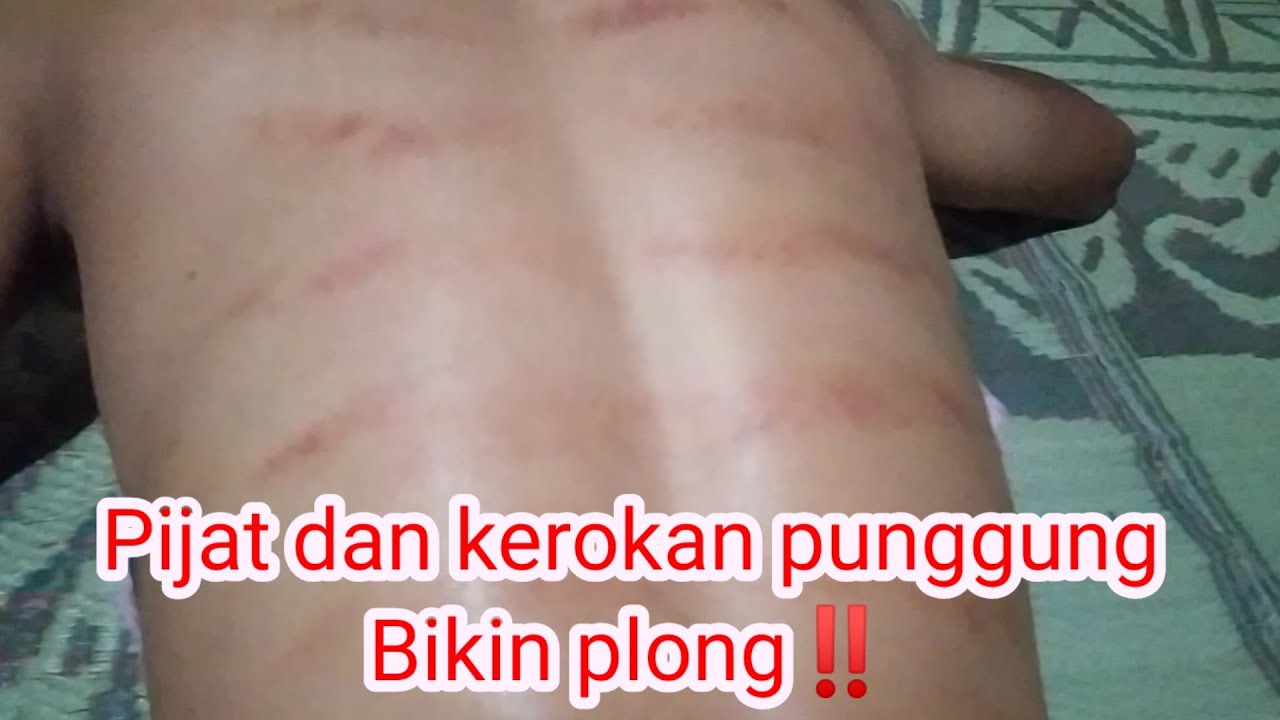 Pijat & Kerokan Punggung Pegal – Badan Langsung Enteng dan plong banget - YouTube