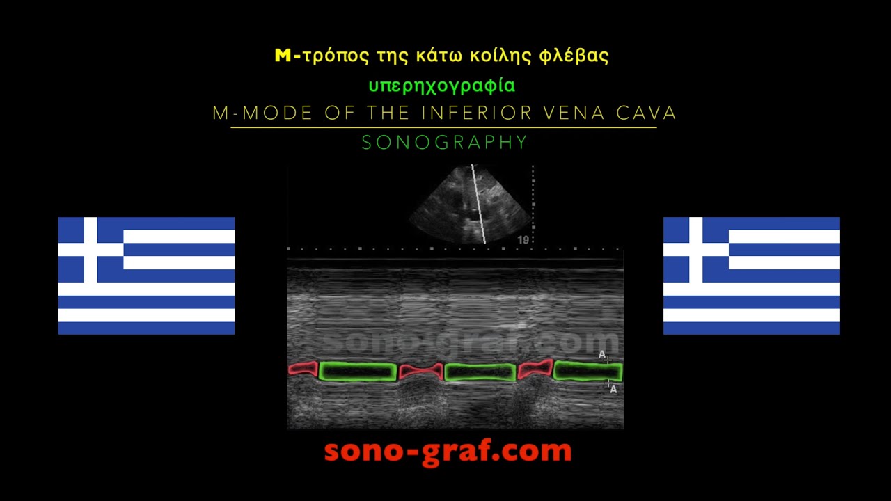 Υπερηχογράφημα - M-mode της κάτω κοίλης φλέβας - YouTube