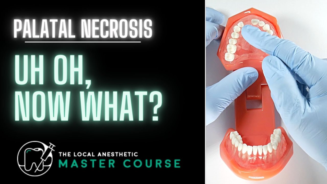 Palatal Necrosis | Online Continuing Dental Education | Local ...