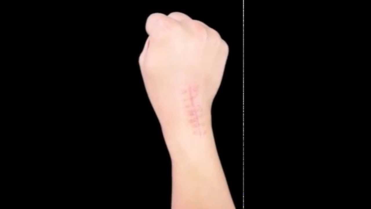 1 Month PRC Range of Motion - YouTube